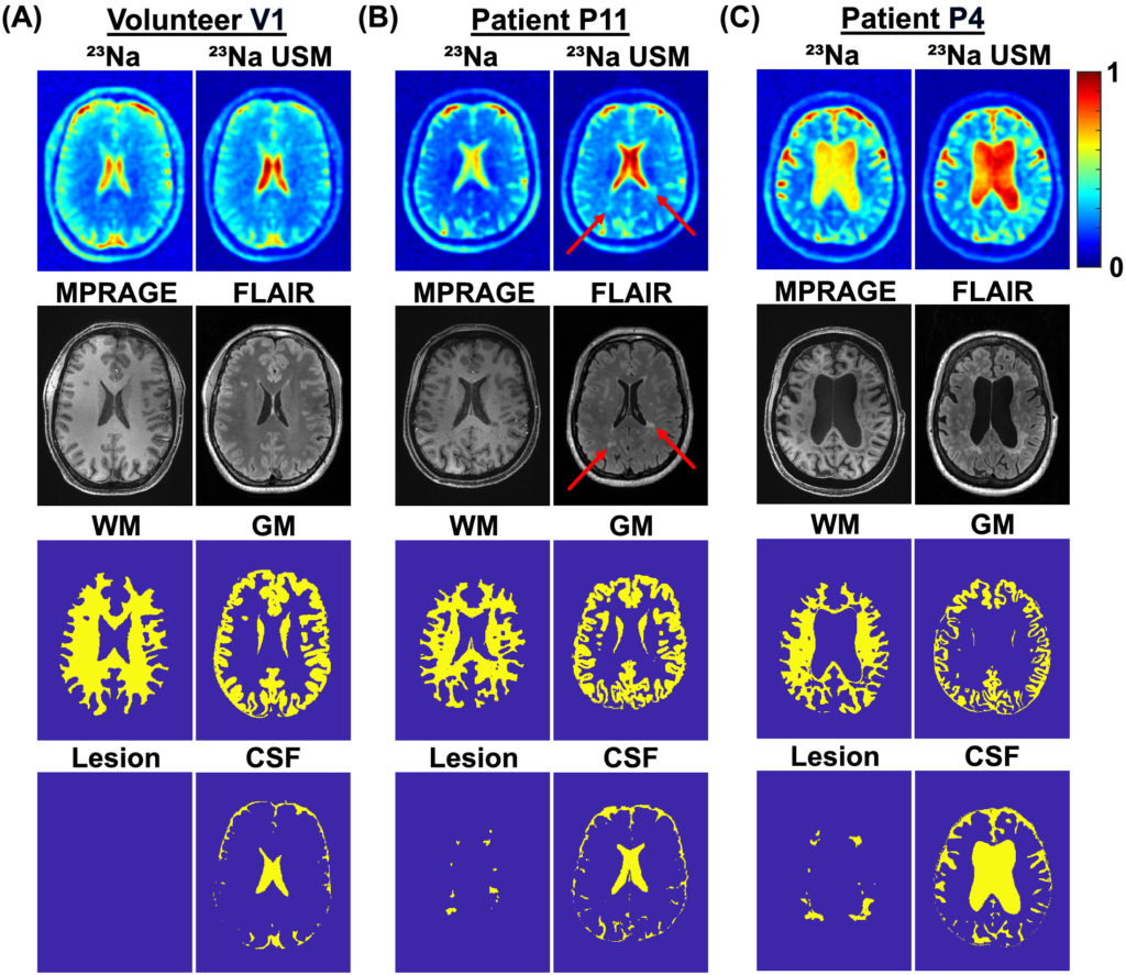 Neues Papier: Quantitative 7T sodium magnetic resonance imaging of the ...