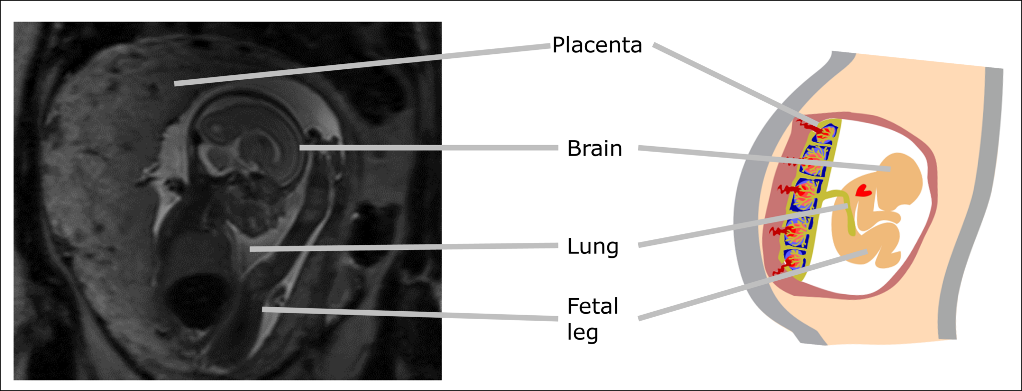 Fetal MRI study MEERKAT - MRT-Forschung am Universitätsklinikum Erlangen